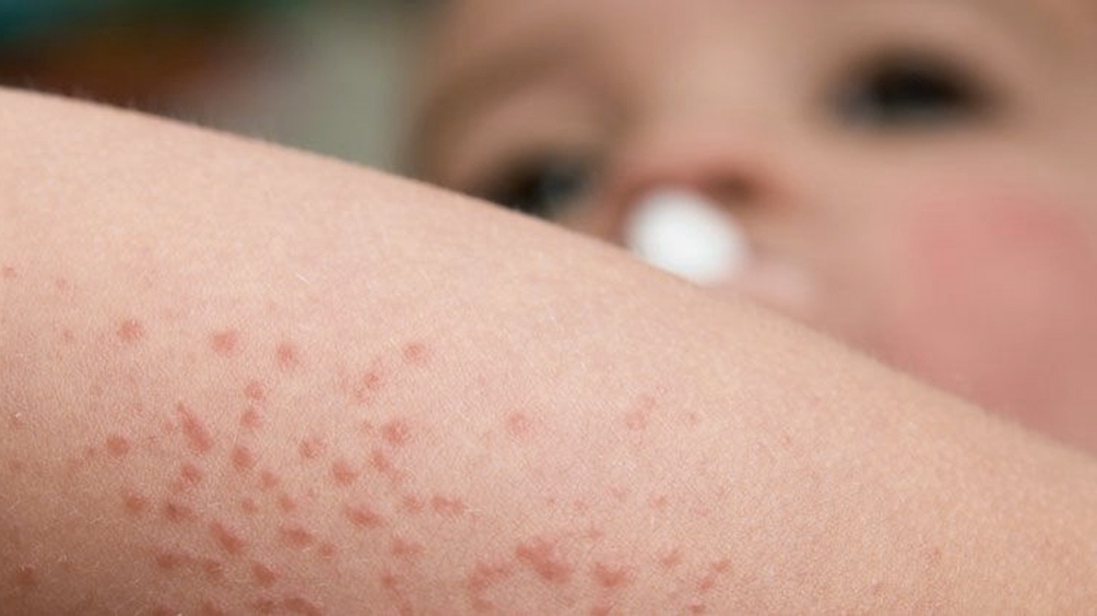 Día Mundial de la Dermatitis Atópica: entre un 15 y 30% de niños y ...