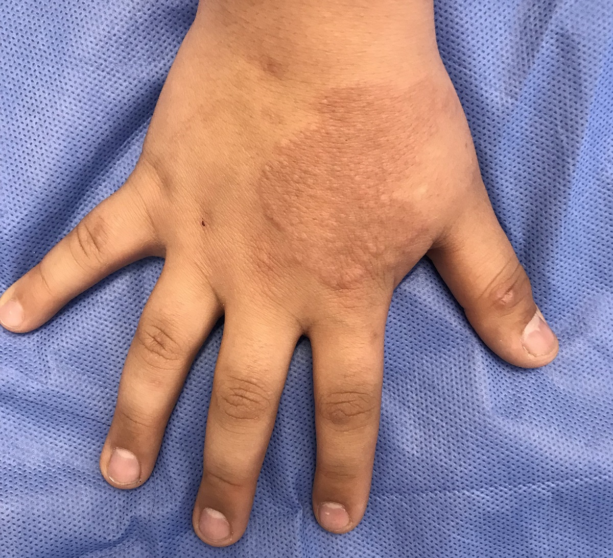 La lepra existe también en la Patagonia y tiene cura - Diario Río Negro