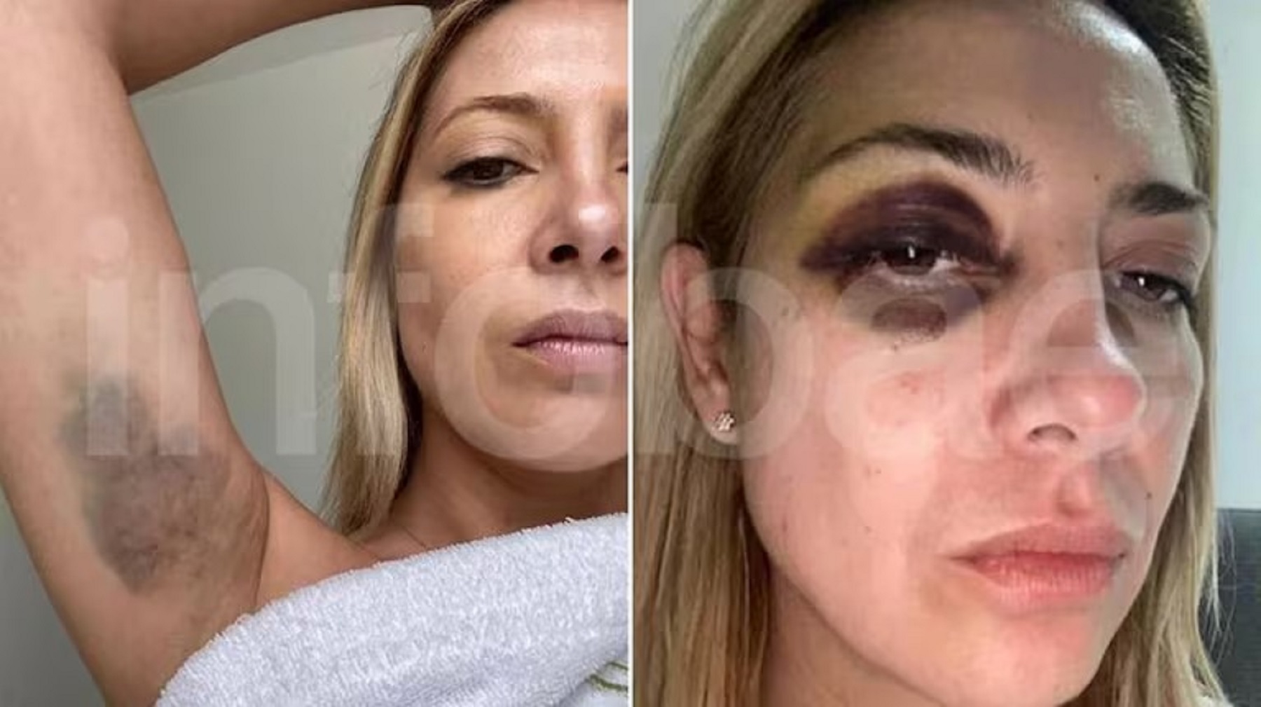 Aparecieron fuertes imágenes de Fabiola Yañez, golpeada, tras la ... Aparecieron fuertes imágenes de Fabiola Yañez, golpeada, tras la ...