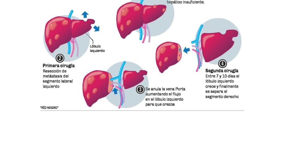 Una cirugía que puede salvar al hígado enfermo